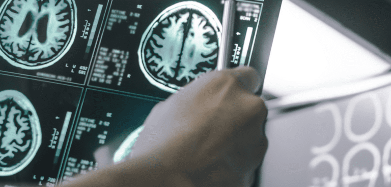 Insights on Brain Simulation Device for Slowing Alzheimer's Symptoms - BHI